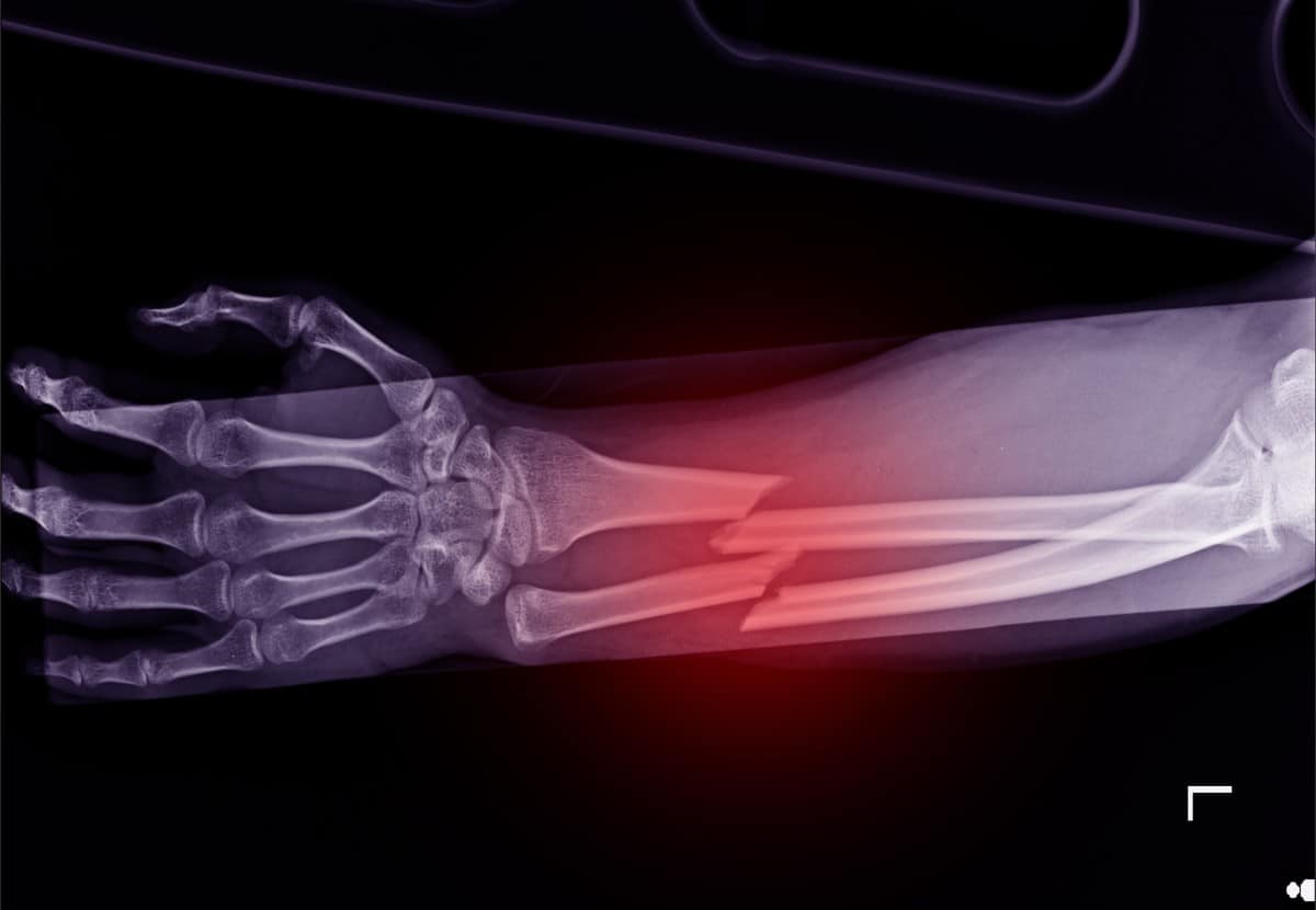 The Facts About Internal Fixation for Broken Bones - Philbrook Law